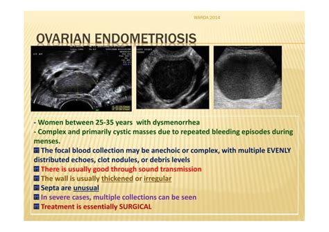 Asymptomatic Palpable Adnexal Masses Ultrasound Evaluation Warda