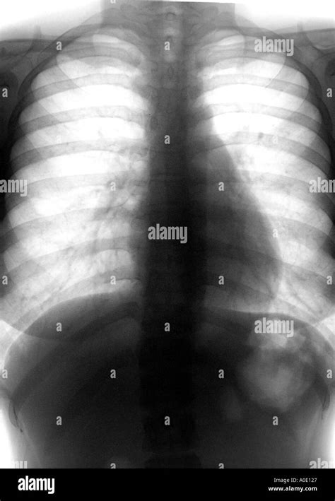 Chest X Ray 21 Weeks Pregnant At Natasha Pamela Blog
