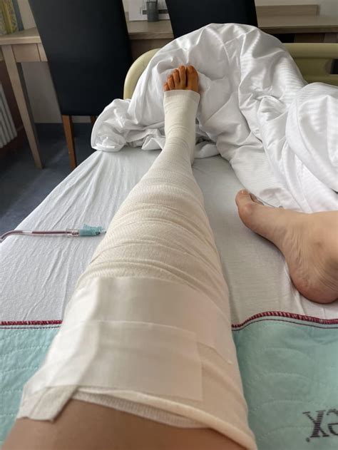 5 Hrs Post Acl Hamstring Graft Reconstruction Racl
