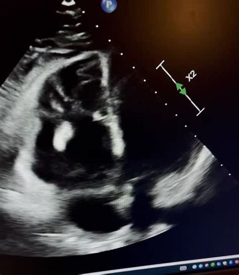 Alexandre D On Linkedin Catheter Assisted Pulmonary Embolectomy