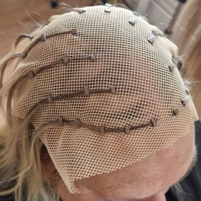 What Is Mesh Integration Hungerford Hair Loss Clinic