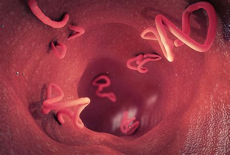 Intestinal Worms Causes Symptoms Diagnosis And More