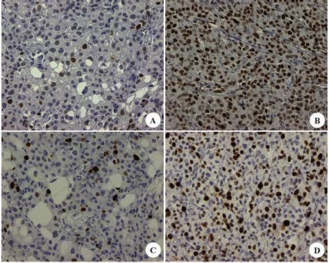Metformin And Melatonin In Adrenocortical Carcinoma Morphoproteomics