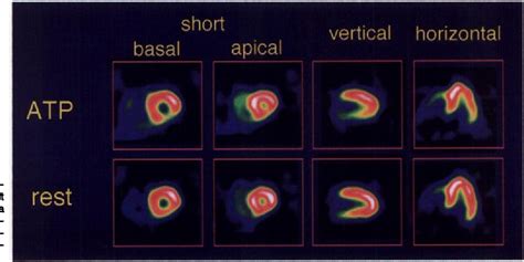 Figure 1 From Myocardial Tomography With Technetium 99m Tetrofosmin During Intravenous Infusion