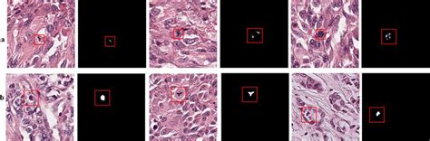 A Multi Phase Deep Cnn Based Mitosis Detection Framework For Breast