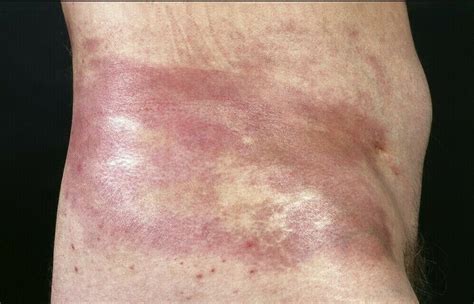Scleroderma Skin Rash