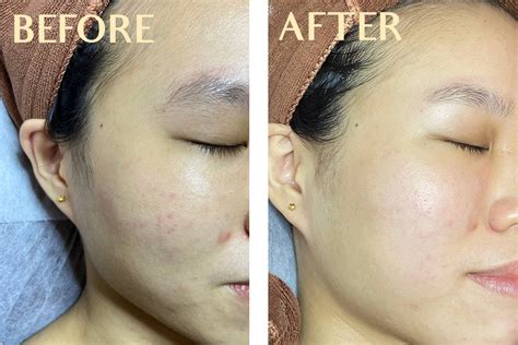 Clogged Pores Bumps