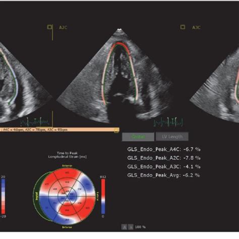 Transthoracic Echocardiography Demonstrating A Classic Cardiac Amyloid Download Scientific
