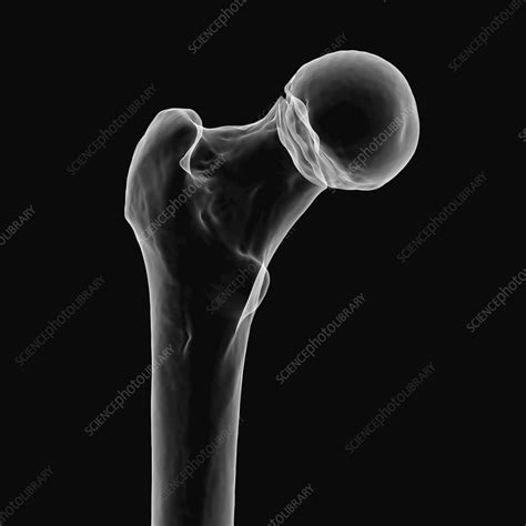 Subcapital Femur Fracture Illustration Stock Image F043 9256 Science Photo Library