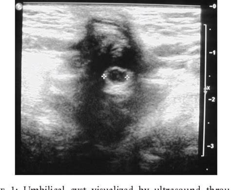 Omphalomesenteric Cyst Semantic Scholar