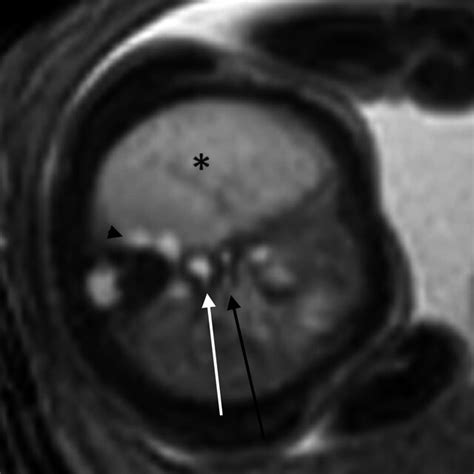 midline sagittal ss‐fse mri sequence of the fetal chest and