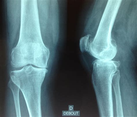 Arthrose Du Genou Dr LEFEBVRE Benjamin