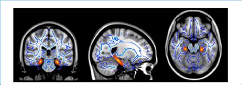 Lower Measures Of Wm Integrity In Bilateral Hippocampal Cingulum Bundle