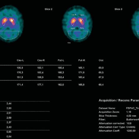 123 I Ioflupane Single Photon Emission Computed Tomography Spect Scan