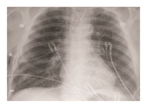 A Chest X Ray Showing Large Right Sided Pneumothorax With Lung Margin Download Scientific