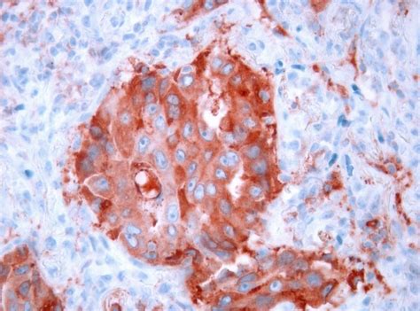 Immunohistochemical Detection Of Sp A Using The Monoclonal Antibody