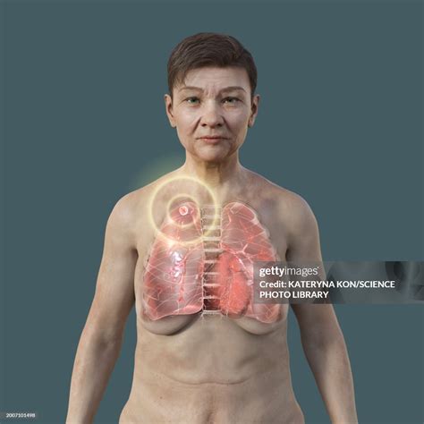 Woman With Apical Tuberculosis Illustration High Res Vector Graphic