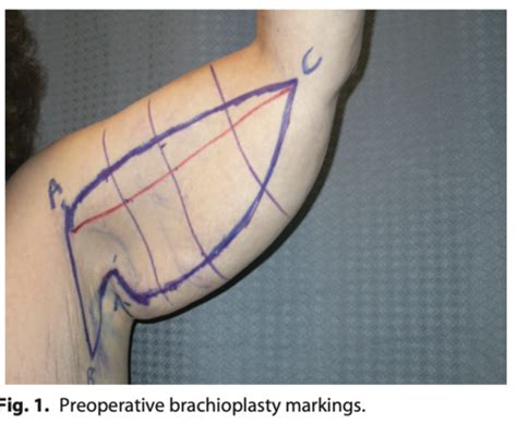 Brachioplasty Flashcards Quizlet
