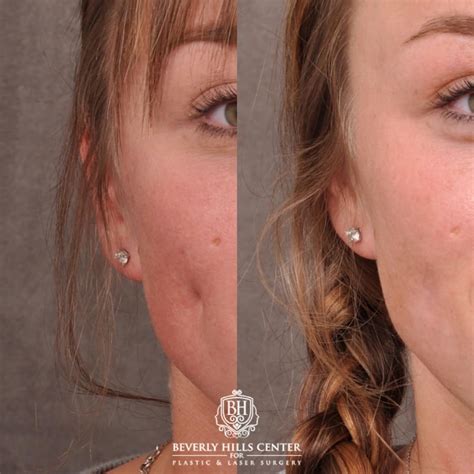 Cheeks Before And Afters Beverly Hills Center