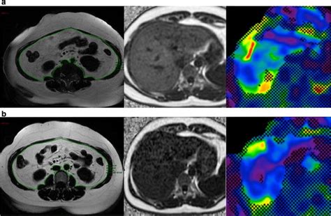 Response To Treatment Through Imaging Findings A Mpmri At Baseline