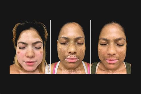 Uvb Treatment For Vitiligo Pregnant Health Tips