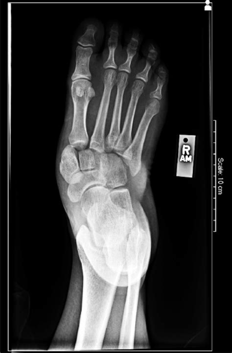Lisfranc Fracture Dislocation Radiograph Pre Reduction Frontal View