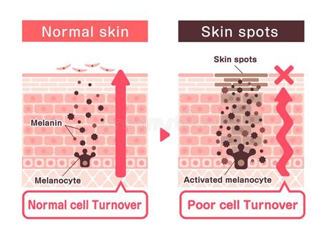 Illustration Of How Skin Spots Hyperpigmentation Are Created Stock