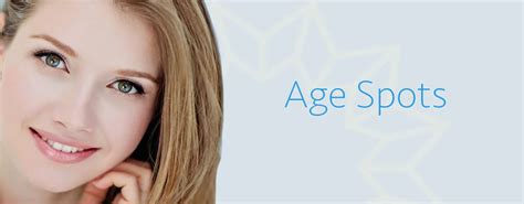 Age Spots Causes How To Get Rid Cream Treatment