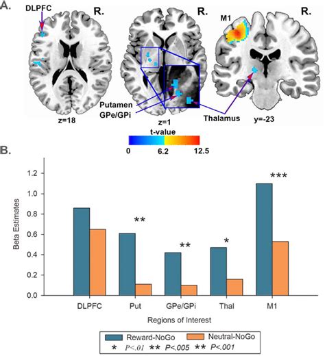 Figure 1 From Reduced Activation In The Pallidal Thalamic Motor Pathway Is Associated With