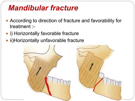 Mandibular Fracture 1pptx