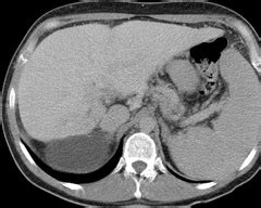 Liver Atlas Case 110 Hereditary Hemochromatosis HH