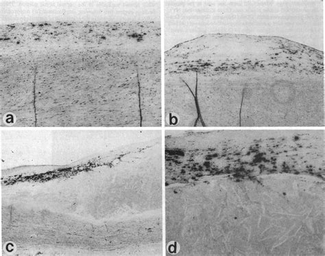 In Situ Hybridization Of Osteopontin Mrna In Atherosclerotic Lesions Of