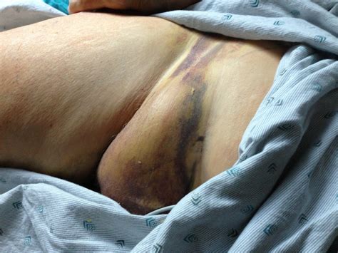 Pseudoaneurysm After Cath Presentation And Thrombin Injection