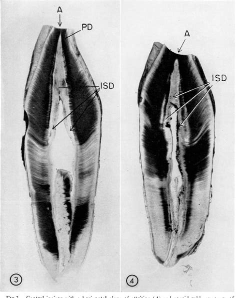 Figure 1 From Location Of Irregular Secondary Dentin Formation
