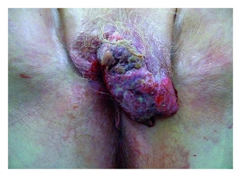 Displasia Vulvar Pin Vulva Vulval Intraepithelial Neoplasia Vin