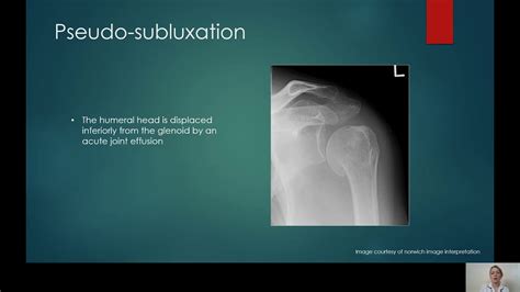 Shoulder X Ray Interpretation Youtube