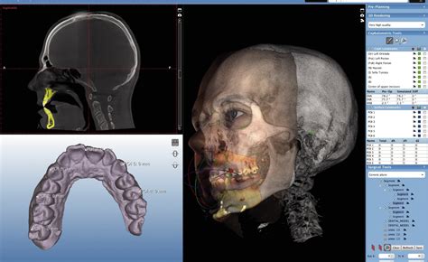 What Is A Cone Beam Scan The Best Picture Of Beam