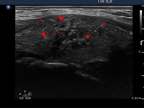 Selected Topics Intranodular Hyperechogenic Figures