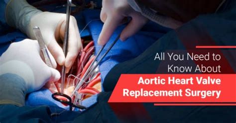 All You Need To Know About Aortic Heart Valve Replacement Surgery By