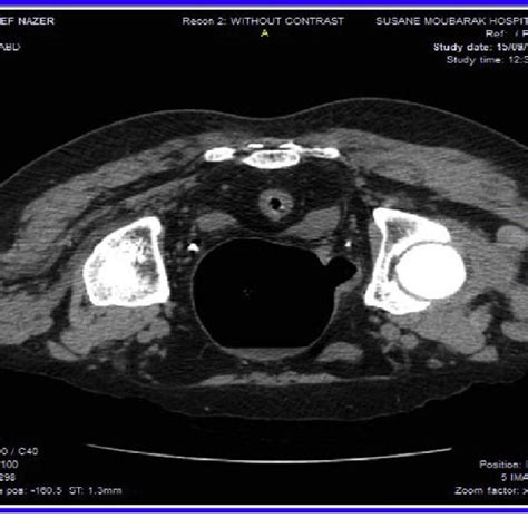 Pdf Ct Virtual Cystoscopy In Evaluation Of Bladder Mass Could It Replace The Gold Standard