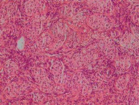 Early Development Of A Gonadal Tumor In A Patient With Mixed Gonadal
