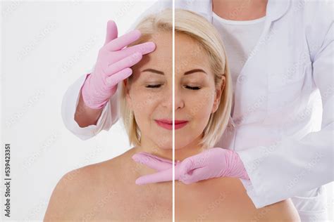 Closeup Woman Middle Age Face Before After Collagen Face Injection