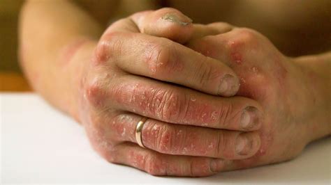 Biggest Psoriasis Mistakes Everyday Health