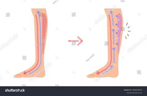 Swelling Legs Illustration Causes Swelling Cross Stock Vector Royalty