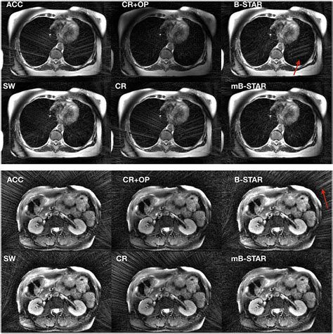 Radial Streak Artifact Reduction Using Phased Array Beamforming Pmc