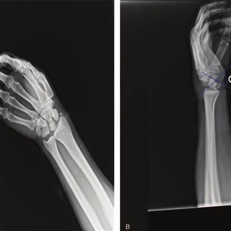 A D 3d Computed Tomography Scan Showing Lunate Dislocation And Download Scientific Diagram