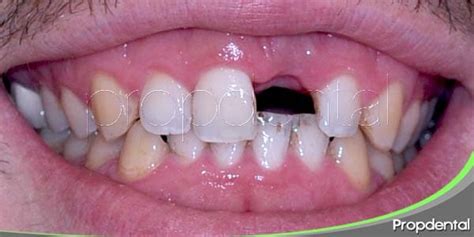 Como Afecta La Pérdida De Una Pieza Dental