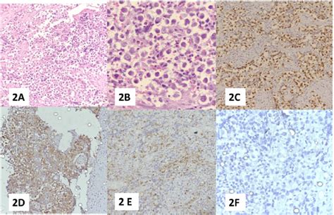 A Histopathology Of Inguinal Lymph Node Showing Tumour Cells H And E