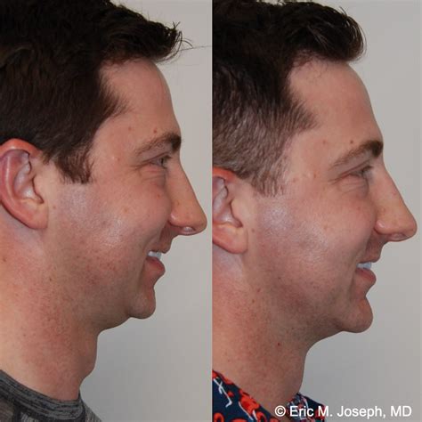 Chin Implant Before And After