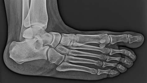 Avulsion Fracture Foot